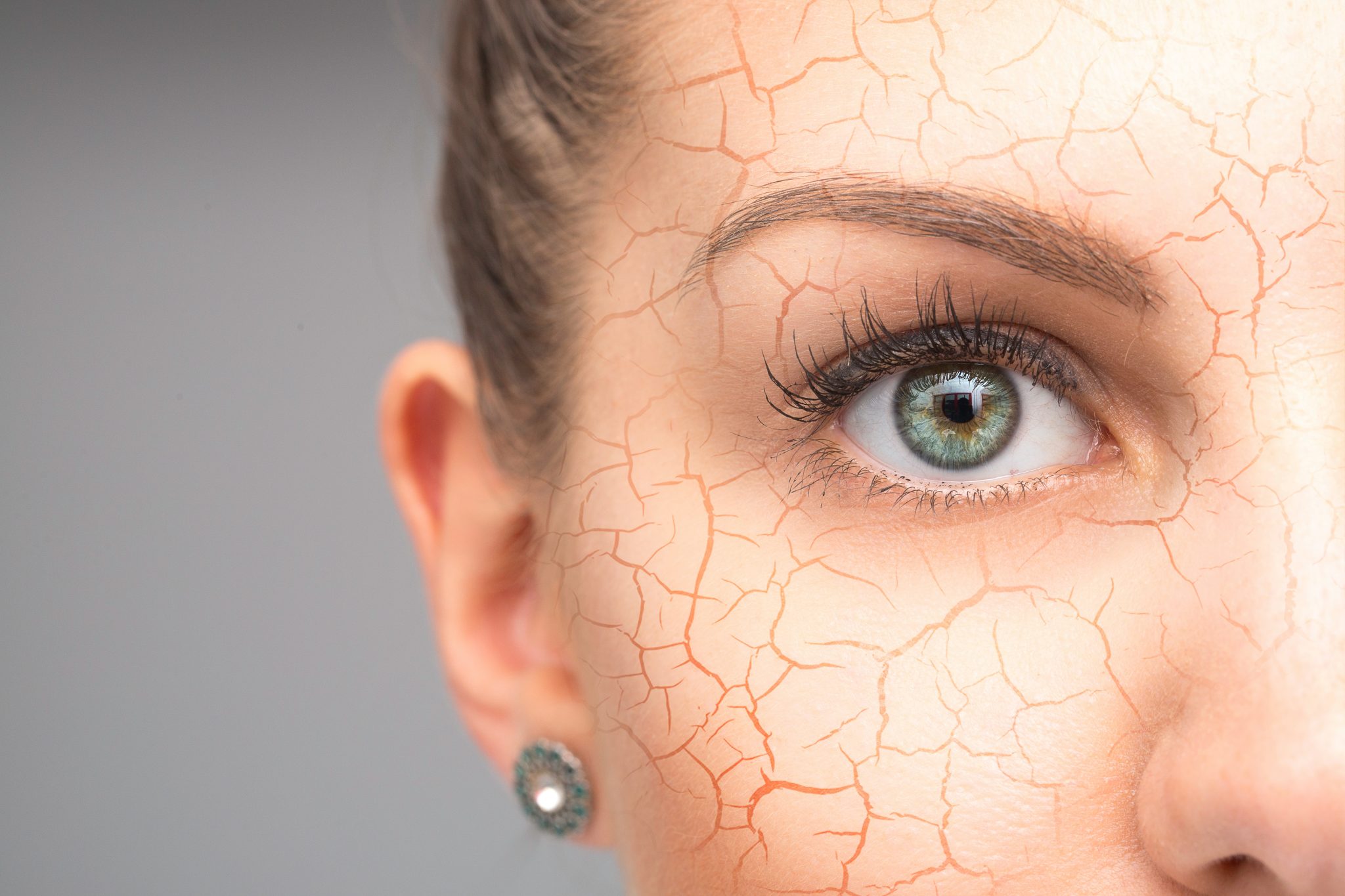 Kutaner Lupus Erythematodes - Information, Diagnose, Therapie